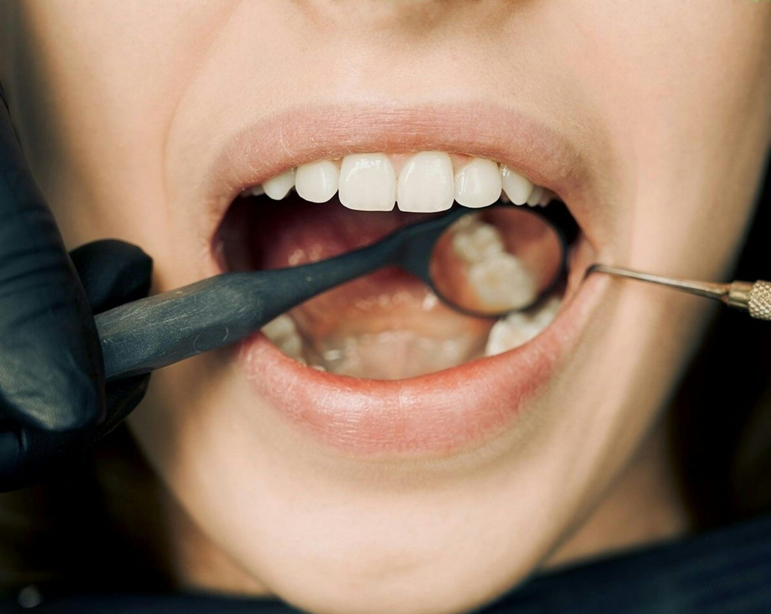 How Often Should You Get A Dental Cleaning? | Kremer Dental Care